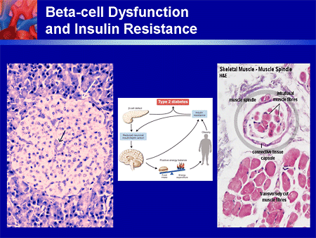Diabetes as a Cardiovascular Disease Equivalent