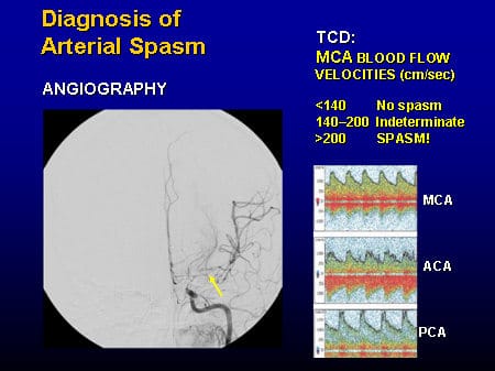 Prevention and Treatment of Vasospasm in Stroke and Subarachnoid ...