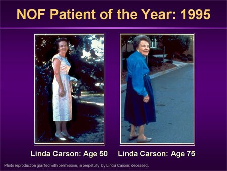 Current Concepts in Osteoporosis