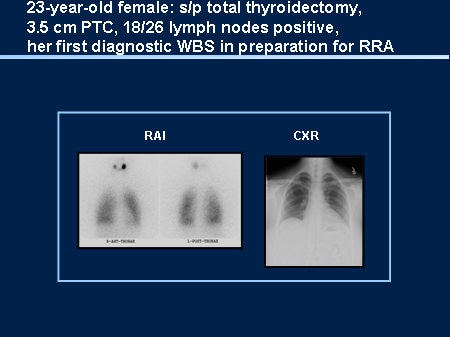 NCCN Thyroid Carcinoma Guidelines Update (Slides with Transcript)