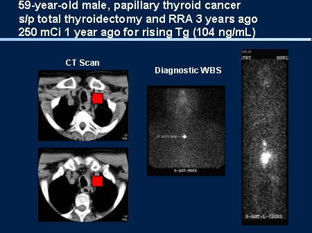 NCCN Thyroid Carcinoma Guidelines Update (Slides with Transcript)
