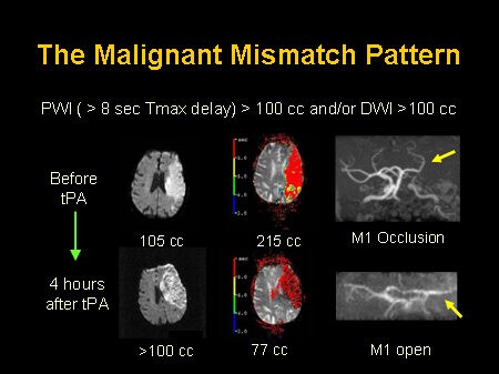 Applying Advances in Brain Imaging in Diagnosing Stroke Selection for ...