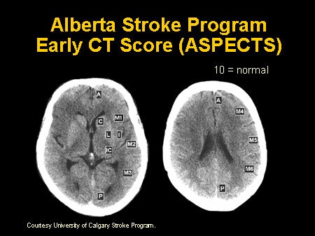 Applying Advances in Brain Imaging in Diagnosing Stroke Selection for tPA (Slides with Transcript)