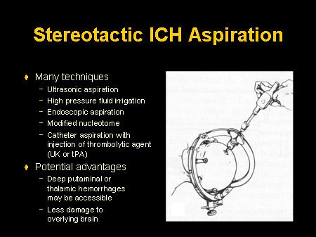 Advances in Intracerebral Hemorrhage Management: 2007 Stroke Update ...