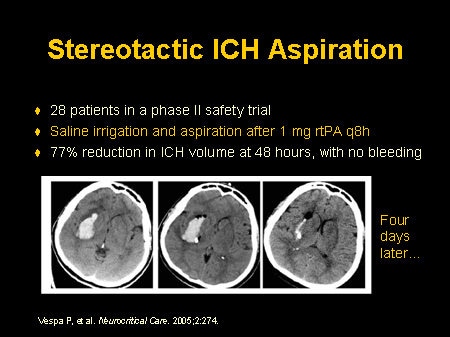 Advances in Intracerebral Hemorrhage Management: 2007 Stroke Update ...