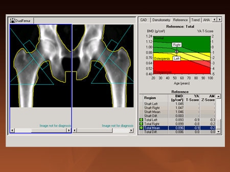 Going Inside and Beyond BMD: New Approaches (Slides with Transcript)