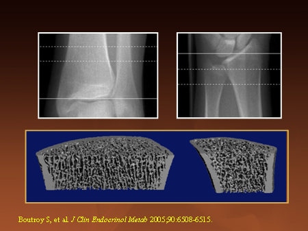 Going Inside and Beyond BMD: New Approaches (Slides with Transcript)