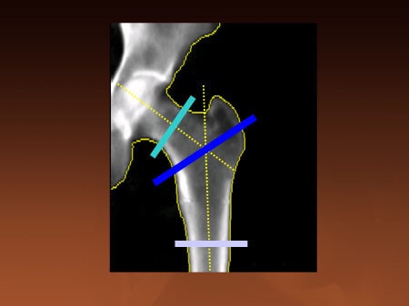 Going Inside and Beyond BMD: New Approaches (Slides with Transcript)