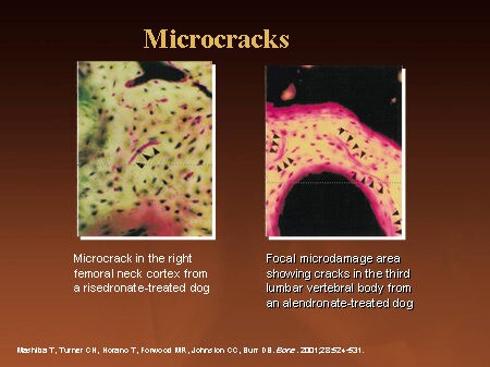 Qualities of Bone and the Effects of Treatment (Slides with Transcript)