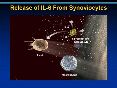 The Role of IL-6 in Inflammatory Diseases (Slides with Transcript)