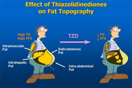 Diabetes, Cardiovascular Disease and Stroke: Mechanisms and Risk Reduction