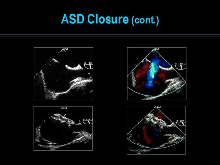 The Role of Interventional Cardiology in CHD (Slides with Transcript)