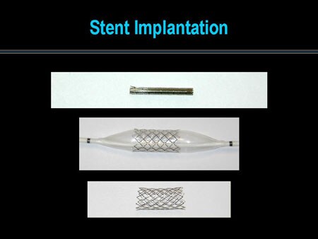 The Role of Interventional Cardiology in CHD (Slides with Transcript)