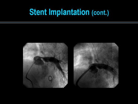 The Role of Interventional Cardiology in CHD (Slides with Transcript)