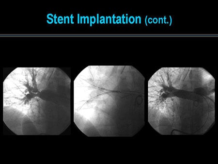 The Role of Interventional Cardiology in CHD (Slides with Transcript)