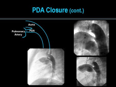 The Role of Interventional Cardiology in CHD (Slides with Transcript)