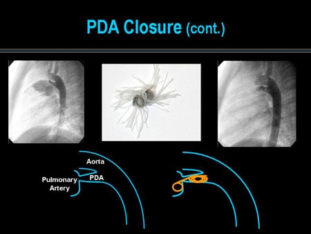 The Role of Interventional Cardiology in CHD (Slides with Transcript)