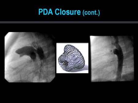 The Role of Interventional Cardiology in CHD (Slides with Transcript)
