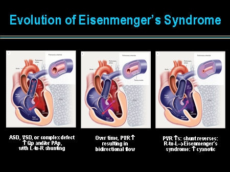 Eisenmenger's Syndrome: Pathophysiologic Insights and Pharmacologic ...