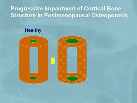 Qualities of Bone and the Effects of Treatment (Slides with Transcript)