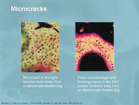 Qualities of Bone and the Effects of Treatment (Slides with Transcript)