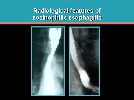 Eosinophilic Esophagitis: More Than Child's Play! (Slides with Transcript)