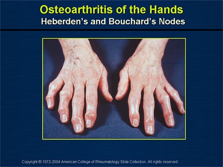 Balancing Gastro-Protective Effects With Cardiovascular Risk