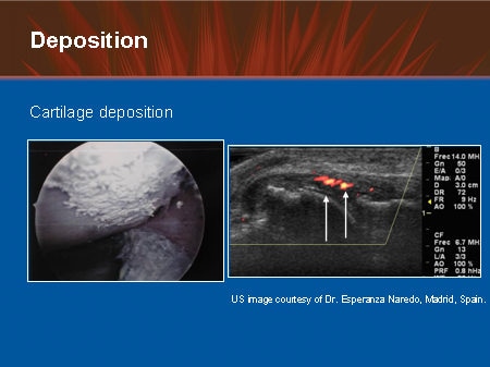 Urate Crystal Deposition, Accumulation, and Inflammation: New Insights ...