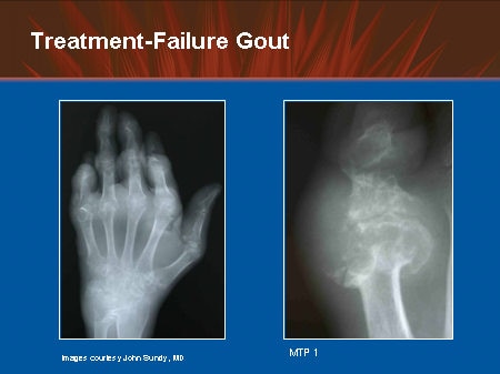 Emerging Strategies for Effective Management of Treatment-Failure Gout ...