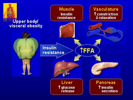 The Impact of Obesity on Type 2 Diabetes: The Role of Visceral Fat ...
