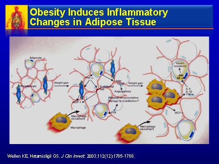 The Impact of Obesity on Type 2 Diabetes: The Role of Visceral Fat ...