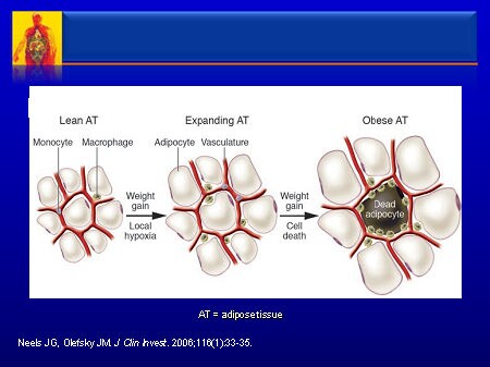 The Impact of Obesity on Type 2 Diabetes: The Role of Visceral Fat ...
