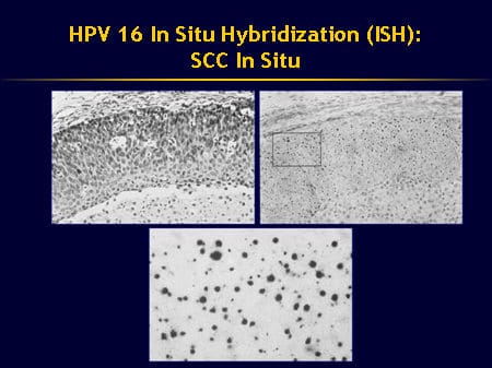 HPV-Related Head and Neck Cancers (Slides With Transcript)