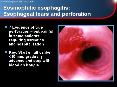 Eosinophilic Esophagitis: New Insights Into an Emerging Concern (Slides ...