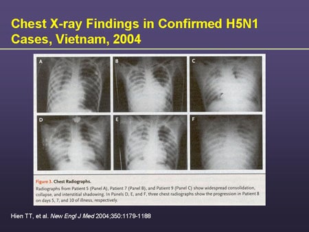 Update on Treatment of Influenza (Slides With Transcript)