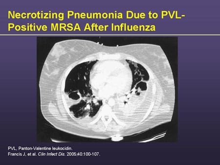 Update on Treatment of Influenza (Slides With Transcript)