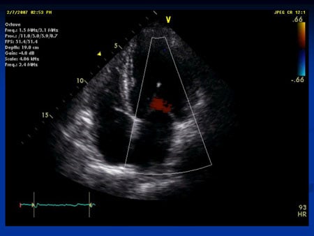 The CRT Clinic: Bringing HF, EP and Echo Together