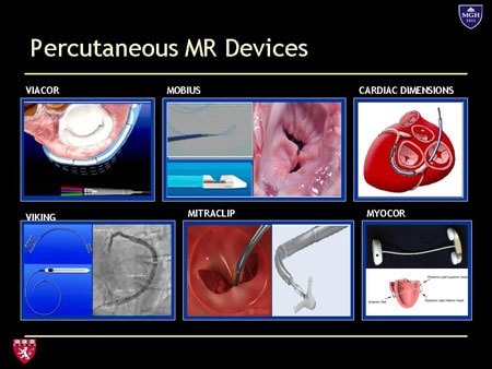 Device Therapy for Heart Failure: What's New on the Horizon?