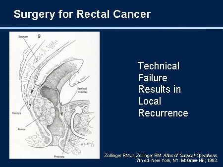 Surgical Approaches to Rectal Cancers (Slides With Transcript)