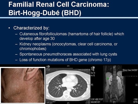 Targeted Therapies in Advanced Renal Cell Carcinoma (Slides With ...