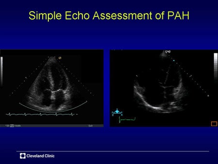 Emerging Role of Advanced Imaging in PAH (Slides With Transcript)