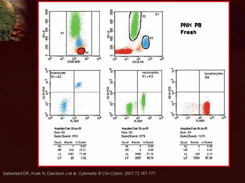 Paroxysmal Nocturnal Hemoglobinuria Diagnosis (Slides With Transcript)