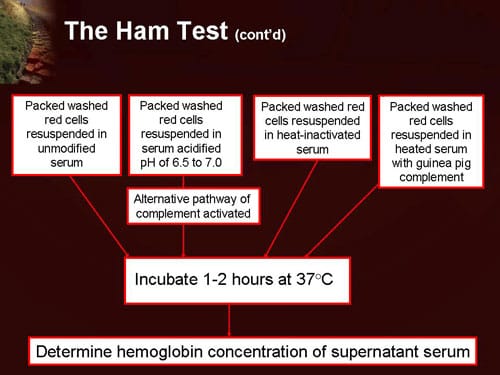 Paroxysmal Nocturnal Hemoglobinuria Diagnosis (Slides With Transcript)