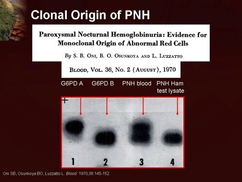 Pathophysiology of Paroxysmal Nocturnal Hemoglobinuria (Slides/Transcript)