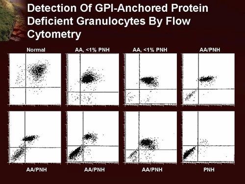 Pathophysiology of Paroxysmal Nocturnal Hemoglobinuria (Slides/Transcript)