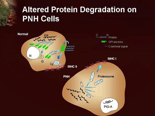 Pathophysiology of Paroxysmal Nocturnal Hemoglobinuria (Slides/Transcript)