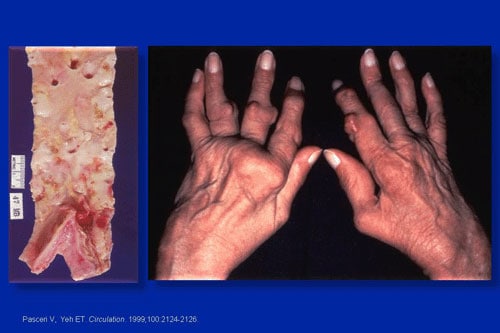 Rheumatoid Arthritis, Inflammation and Cardiovascular Disease