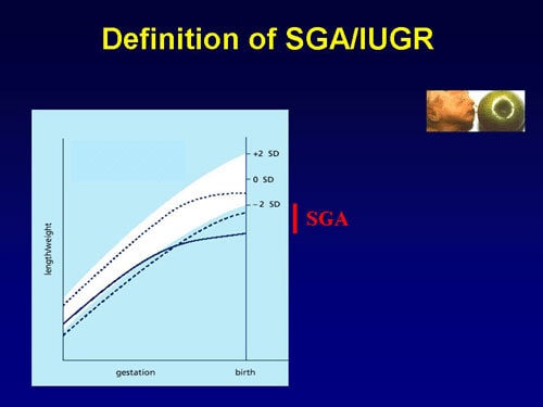 The Treatment of Growth Failure in SGA Children (Slides With Transcript)
