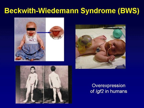 Genetic Determinants of Size at Birth (Slides With Transcript)