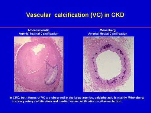 Managing Phosphorus in Chronic Kidney Disease (Slides With Transcript)
